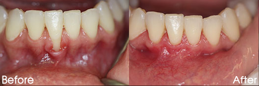 Soft Tissue Grafting | Gum Tissue Graft Surgery