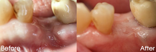 Ridge Augmentation Los Angeles | Ridge Augmentation Beverly Hills